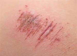 Hoe behandel je een schaafwond in 7 stappen - 101BHV.nl